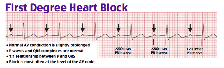 ACLS Cardiac EKG Arrhythmias and Treatments Cheat Sheet