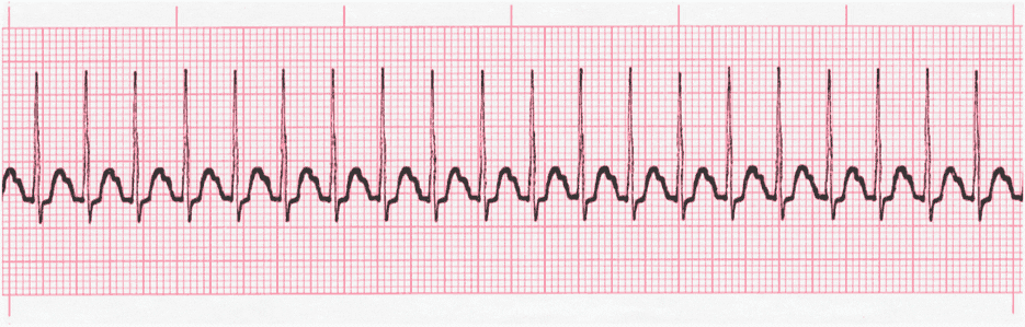 ACLS Cardiac EKG Arrhythmias and Treatments Cheat Sheet