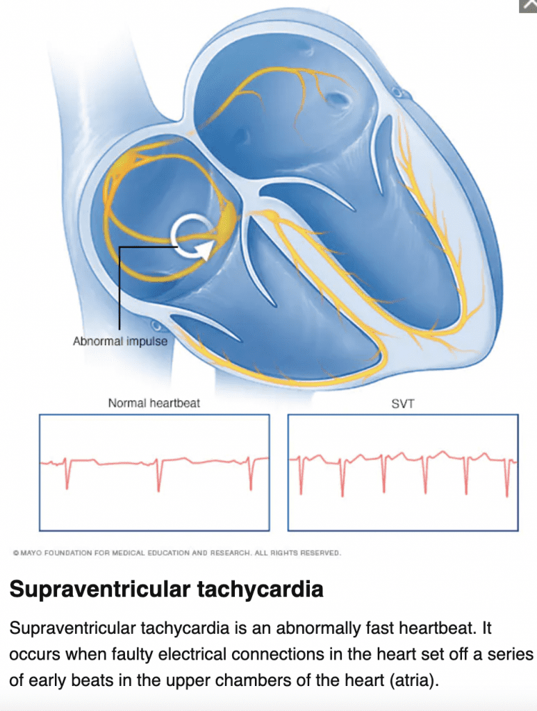 ACLS Cardiac EKG Arrhythmias and Treatments Cheat Sheet
