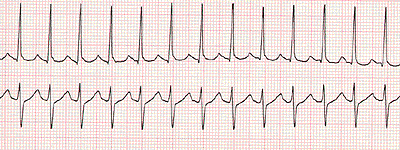 ACLS Cardiac EKG Arrhythmias and Treatments Cheat Sheet