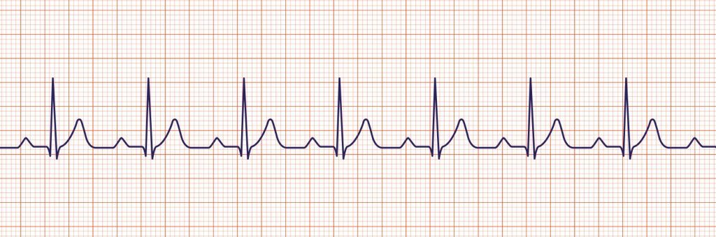 ACLS Cardiac EKG Arrhythmias and Treatments Cheat Sheet