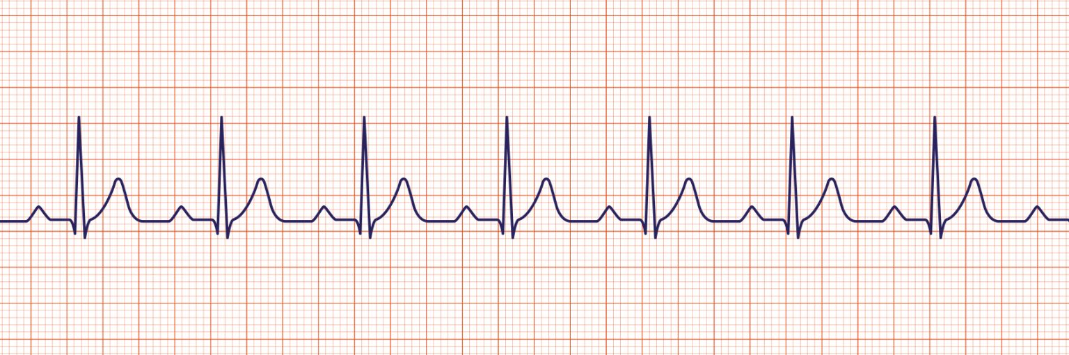 ACLS Cardiac EKG Arrhythmias and Treatments Cheat Sheet