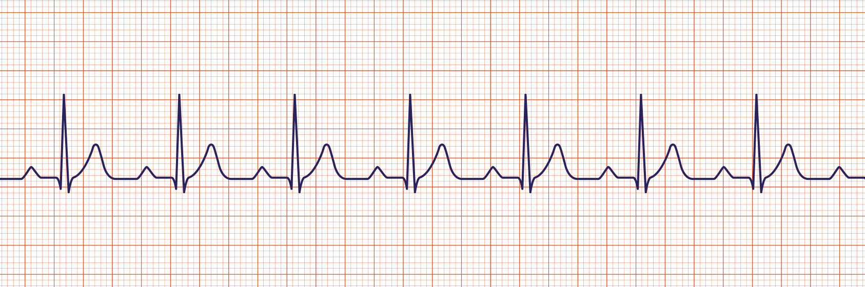 ACLS Cardiac EKG Arrhythmias and Treatments Cheat Sheet