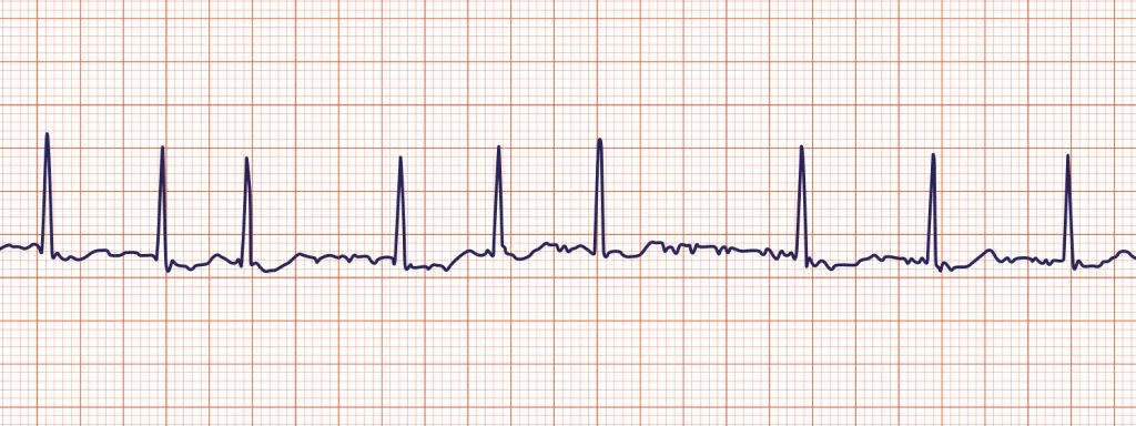 ACLS Cardiac EKG Arrhythmias and Treatments Cheat Sheet