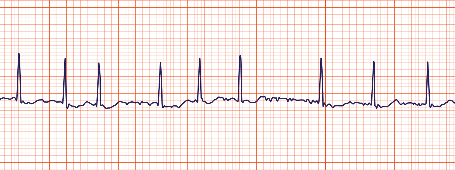 ACLS Cardiac EKG Arrhythmias and Treatments Cheat Sheet