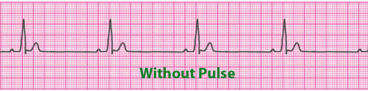 Pulseless Electrical Activity Rhythm Strip