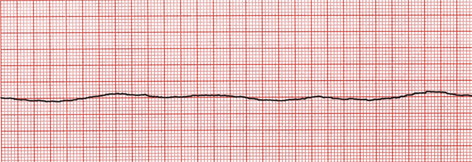 ACLS Cardiac EKG Arrhythmias and Treatments Cheat Sheet