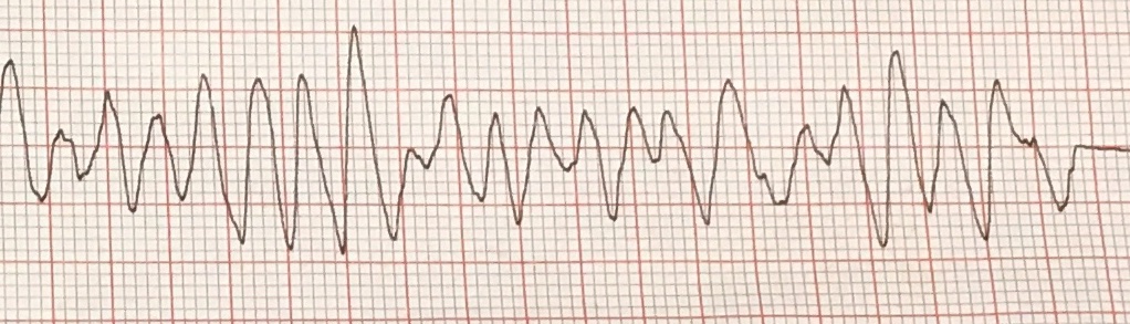 ACLS Cardiac EKG Arrhythmias and Treatments Cheat Sheet