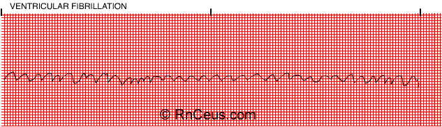 ACLS Cardiac EKG Arrhythmias and Treatments Cheat Sheet
