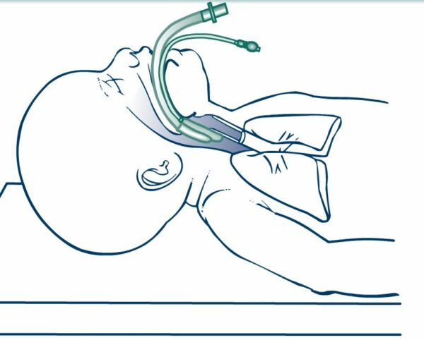 Mastering NRP Skills: Essential Steps in Resuscitation