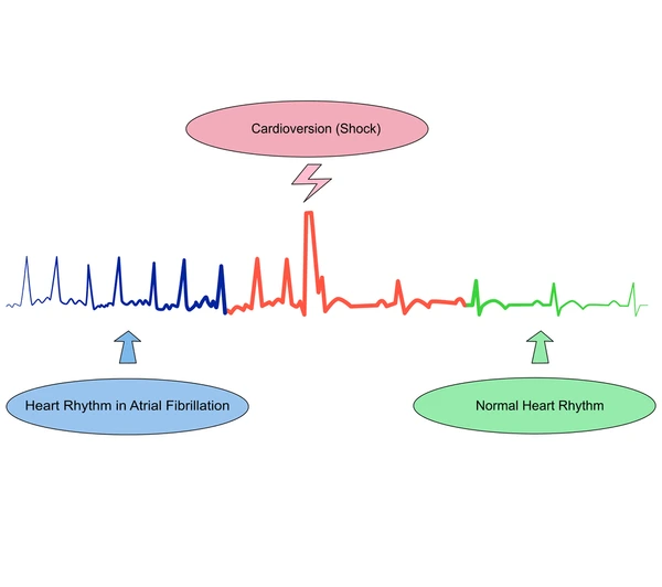 ACLS Defibrillation Doses: Monophasic and Biphasic AED Guidelines